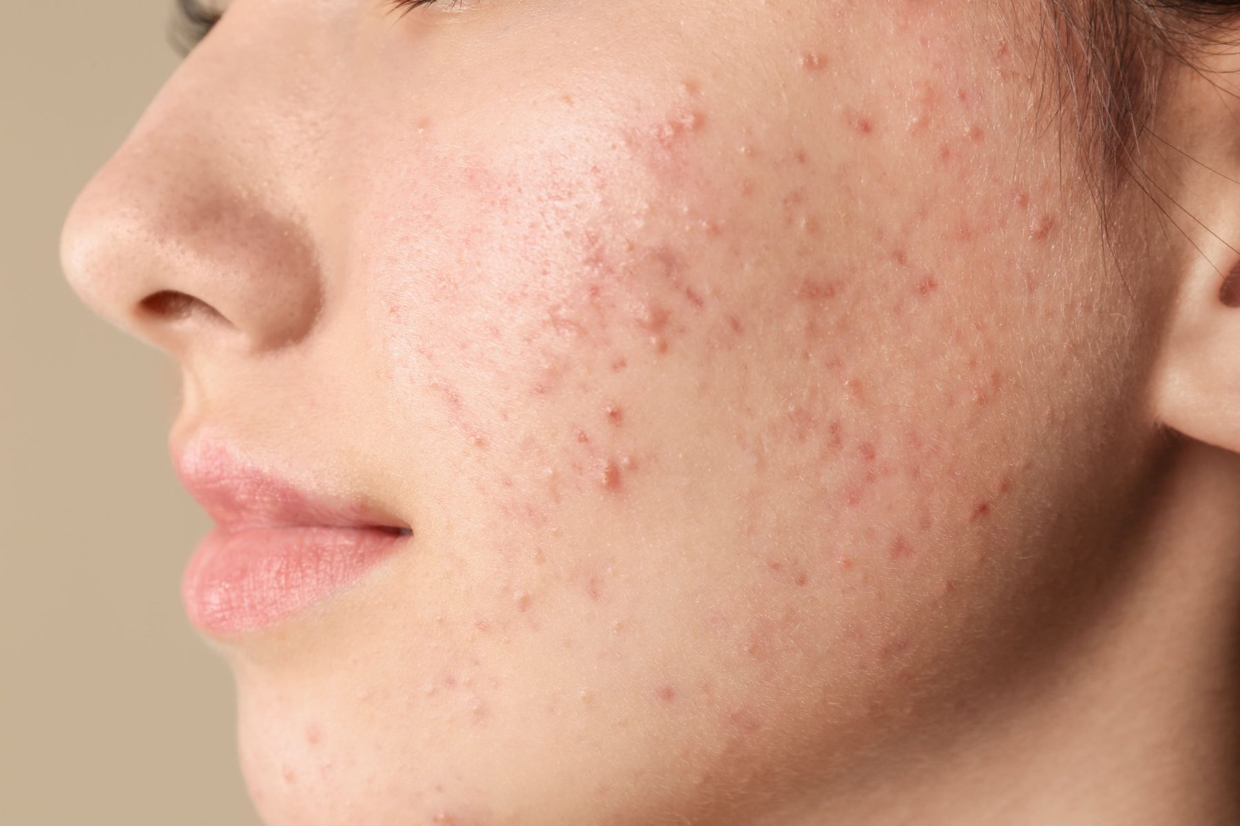 Acne - Dermatology & Skin Surgery Specialists